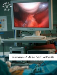 Rimozione della cisti vescicali: procedura e recupero - UrologoMed